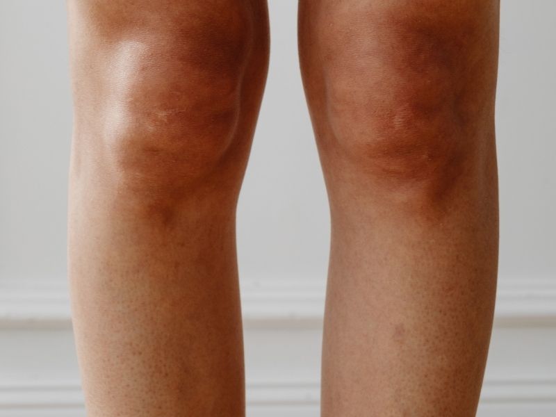 Çarpık Bacak Tedavisi - Ankara Çocuk Ortopedi ve Travmatoloji Uzmanı